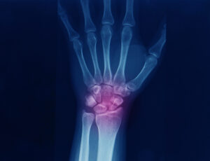 Scaphoid Fractures: The Wrist Injury That’s Easy to Miss